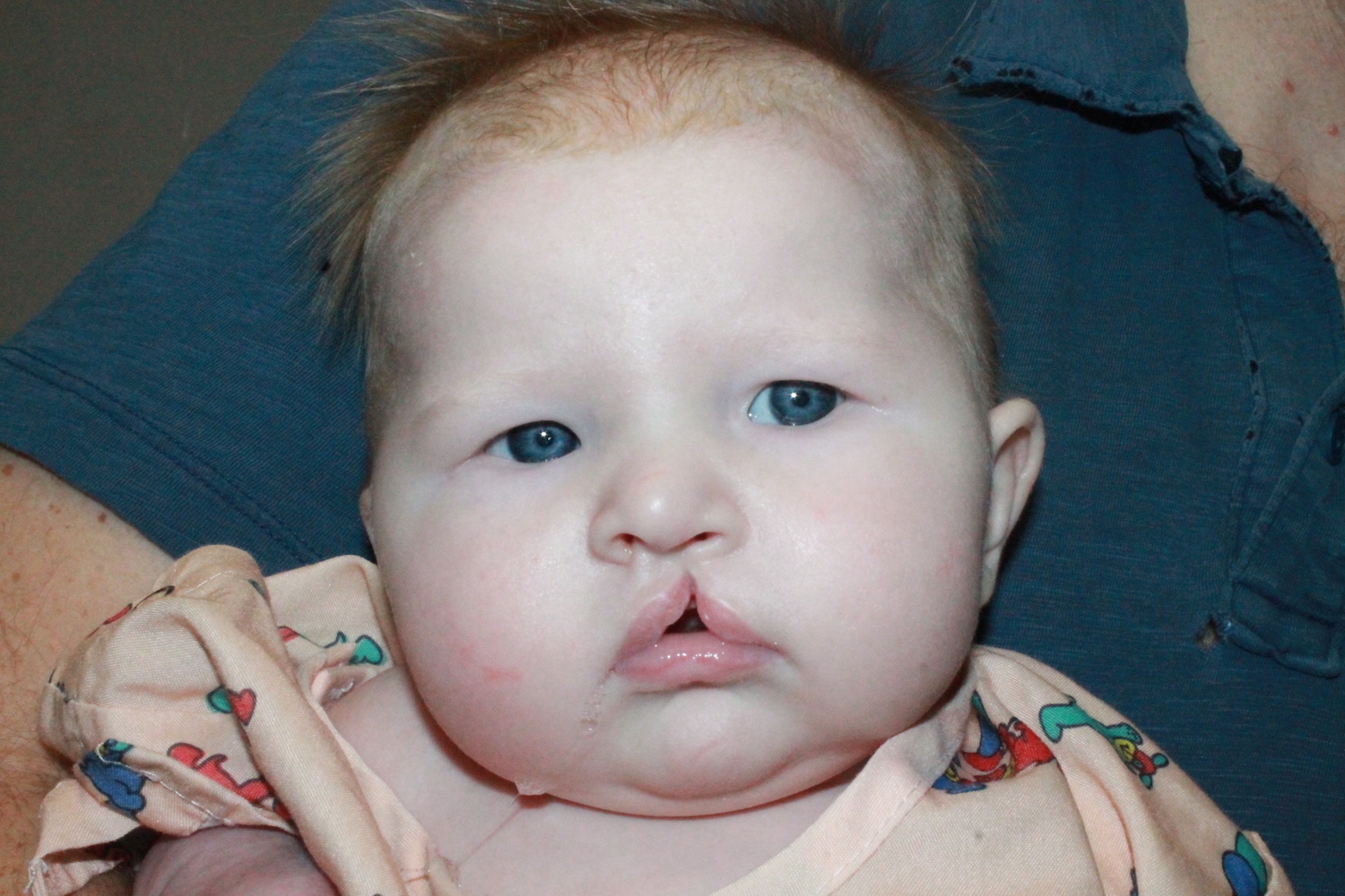 Before & After Archive - Kansas Cleft and Craniofacial Center