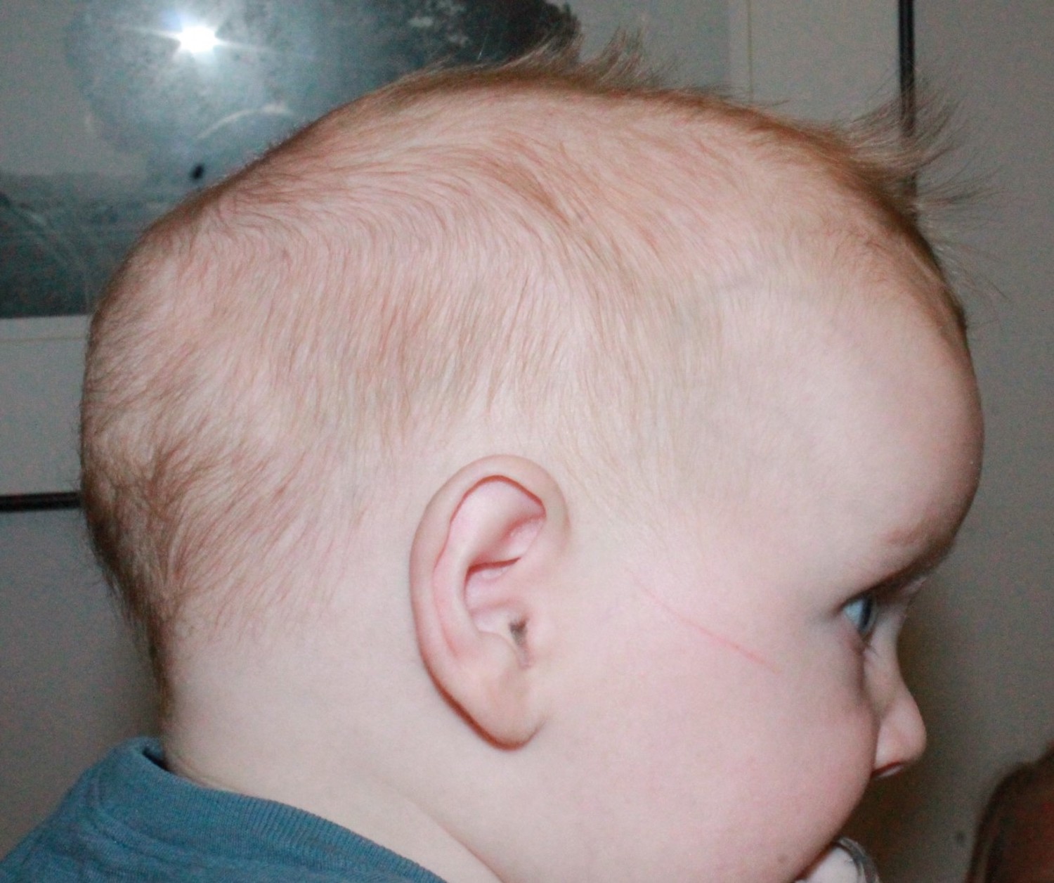 Before & After Archive - Kansas Cleft and Craniofacial Center